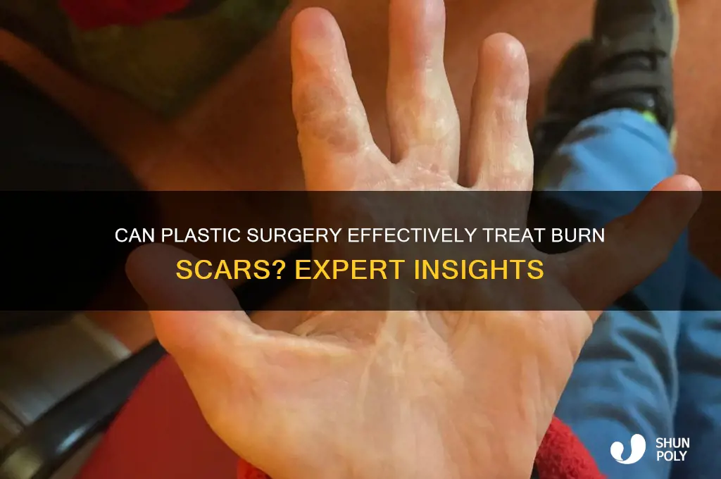 Can Plastic Surgery Effectively Treat Burn Scars? Expert Insights ...