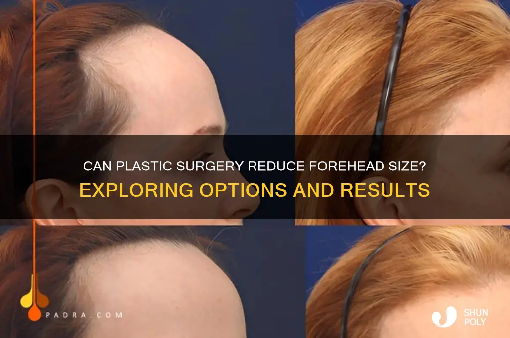 Can Plastic Surgery Reduce Forehead Size? Exploring Options And Results ...