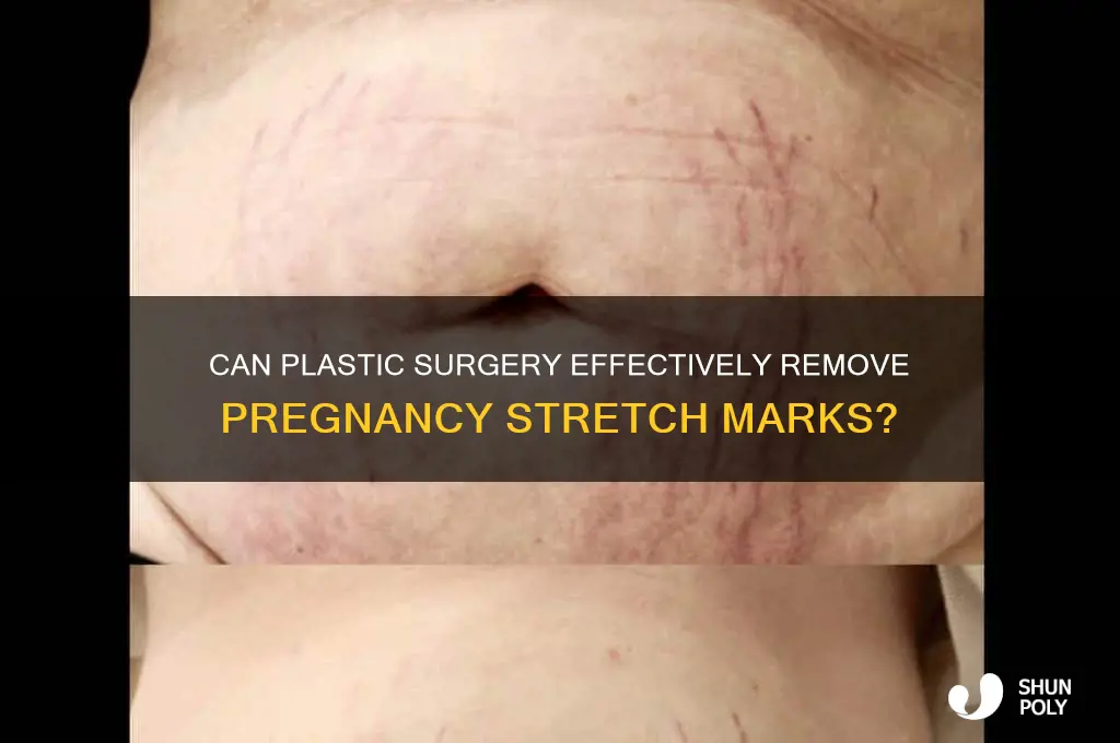 Can Plastic Surgery Effectively Remove Pregnancy Stretch Marks? | ShunPoly