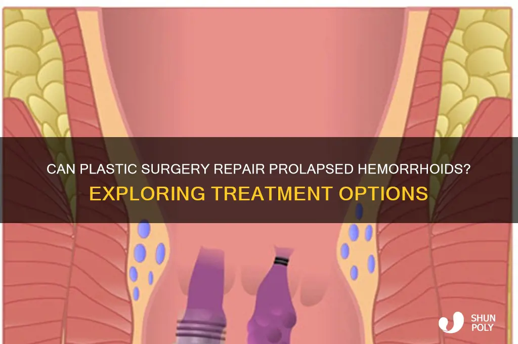 Can Plastic Surgery Repair Prolapsed Hemorrhoids? Exploring Treatment ...