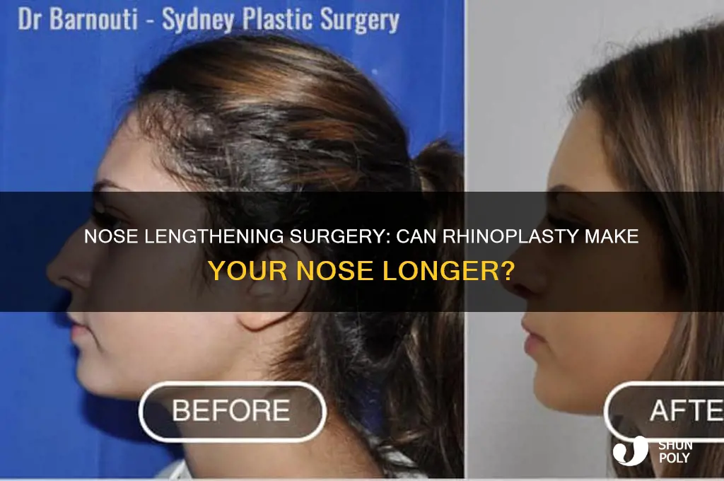 Nose Lengthening Surgery: Can Rhinoplasty Make Your Nose Longer? | ShunPoly