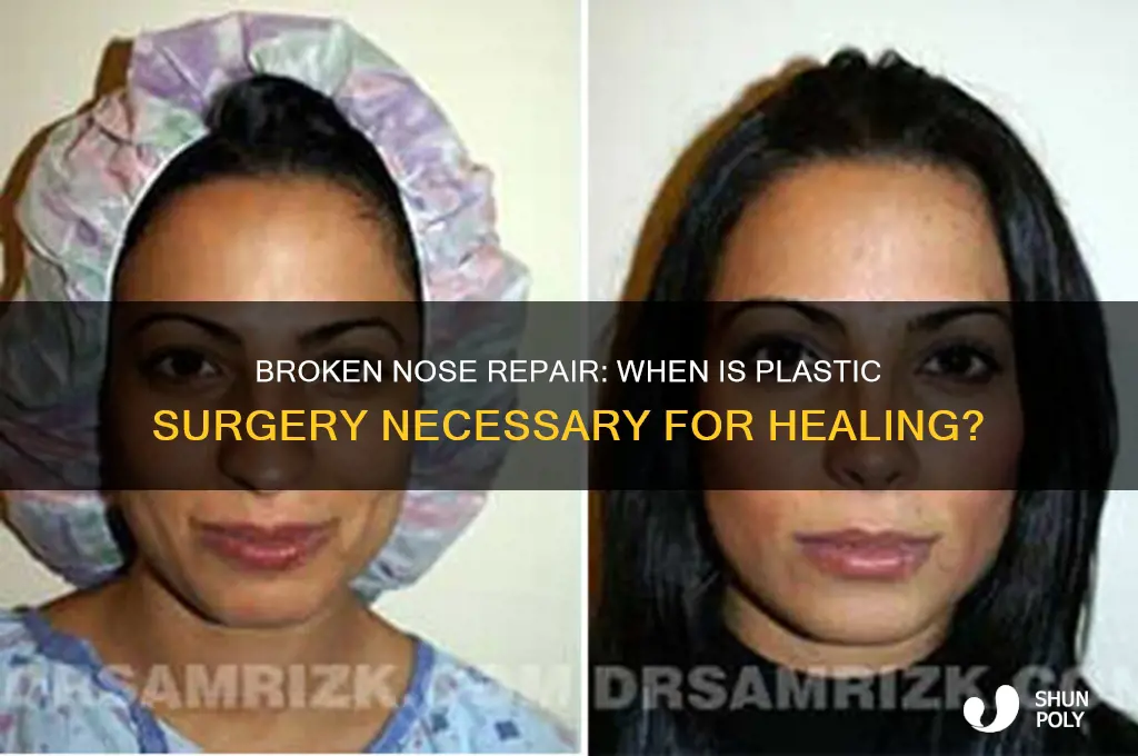 Broken Nose Repair: When Is Plastic Surgery Necessary For Healing ...