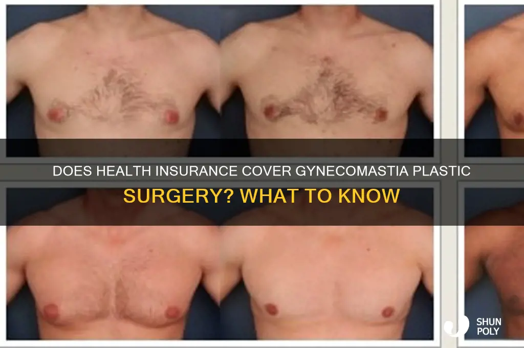 Does Health Insurance Cover Gynecomastia Plastic Surgery? What To Know ...