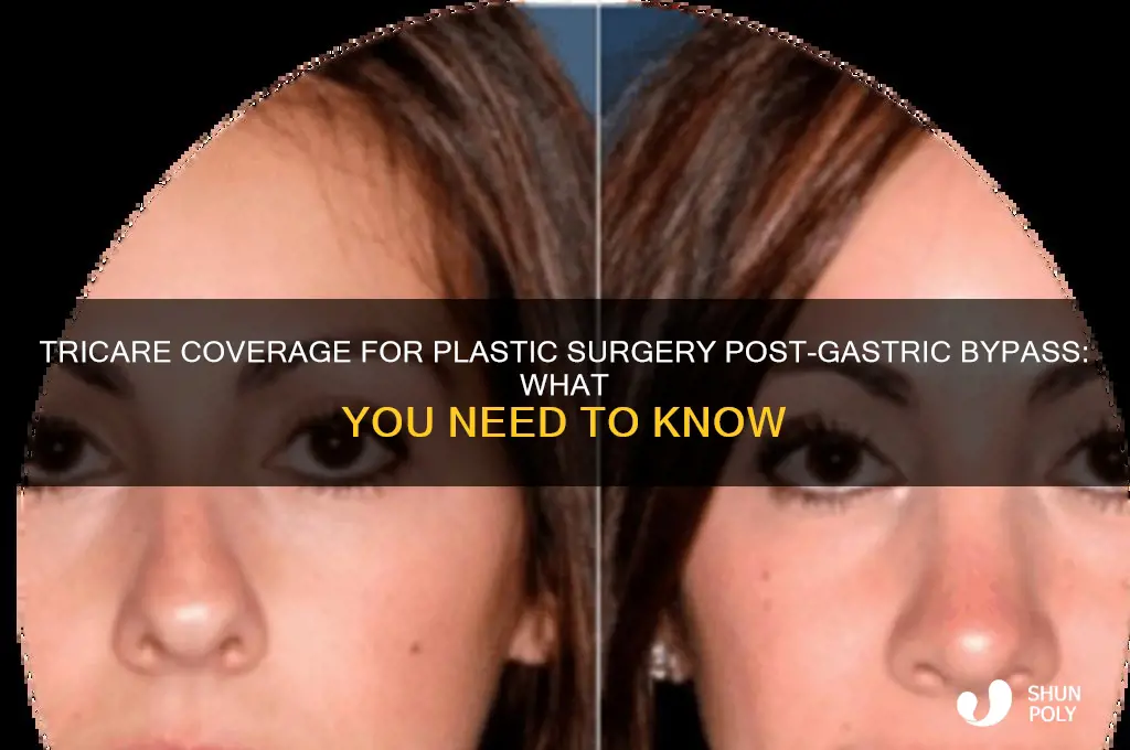 Tricare Coverage For Plastic Surgery Post-Gastric Bypass: What You Need ...