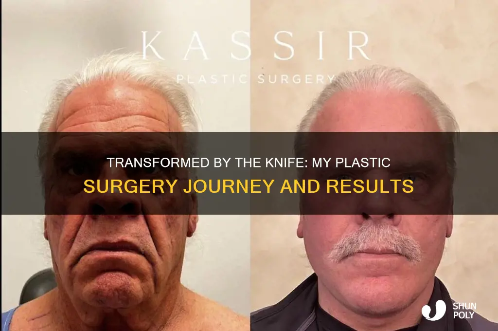 Transformed By The Knife: My Plastic Surgery Journey And Results | ShunPoly
