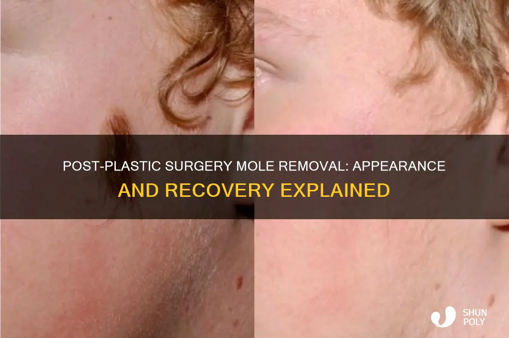 Post-Plastic Surgery Mole Removal: Appearance And Recovery Explained ...