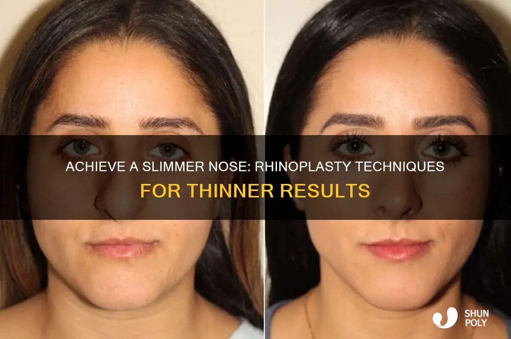 Achieve A Slimmer Nose: Rhinoplasty Techniques For Thinner Results ...