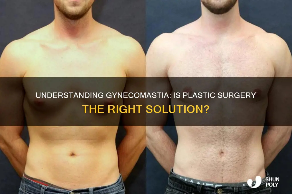 Understanding Gynecomastia: Is Plastic Surgery The Right Solution ...