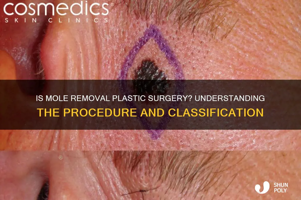 Is Mole Removal Plastic Surgery? Understanding The Procedure And ...
