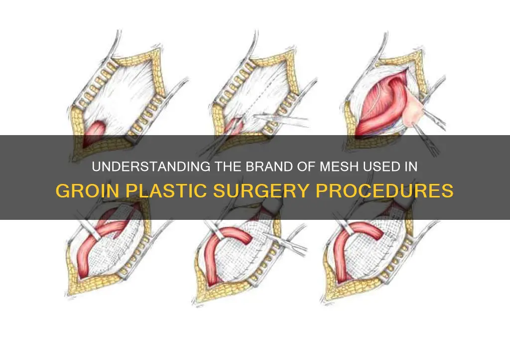 Understanding The Brand Of Mesh Used In Groin Plastic Surgery ...