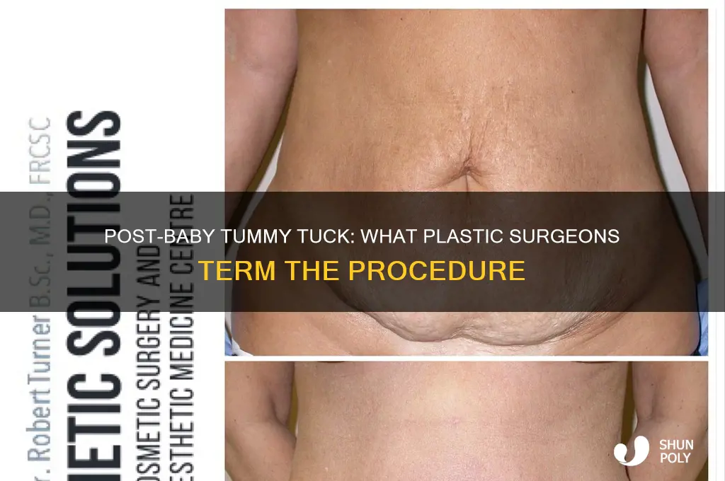 Post-Baby Tummy Tuck: What Plastic Surgeons Term The Procedure | ShunPoly