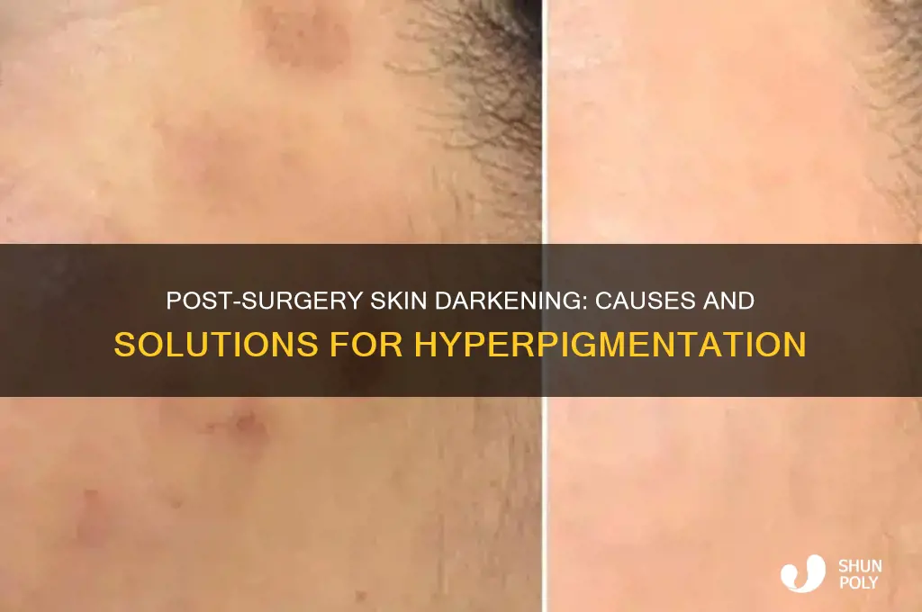 Post-Surgery Skin Darkening: Causes And Solutions For Hyperpigmentation ...